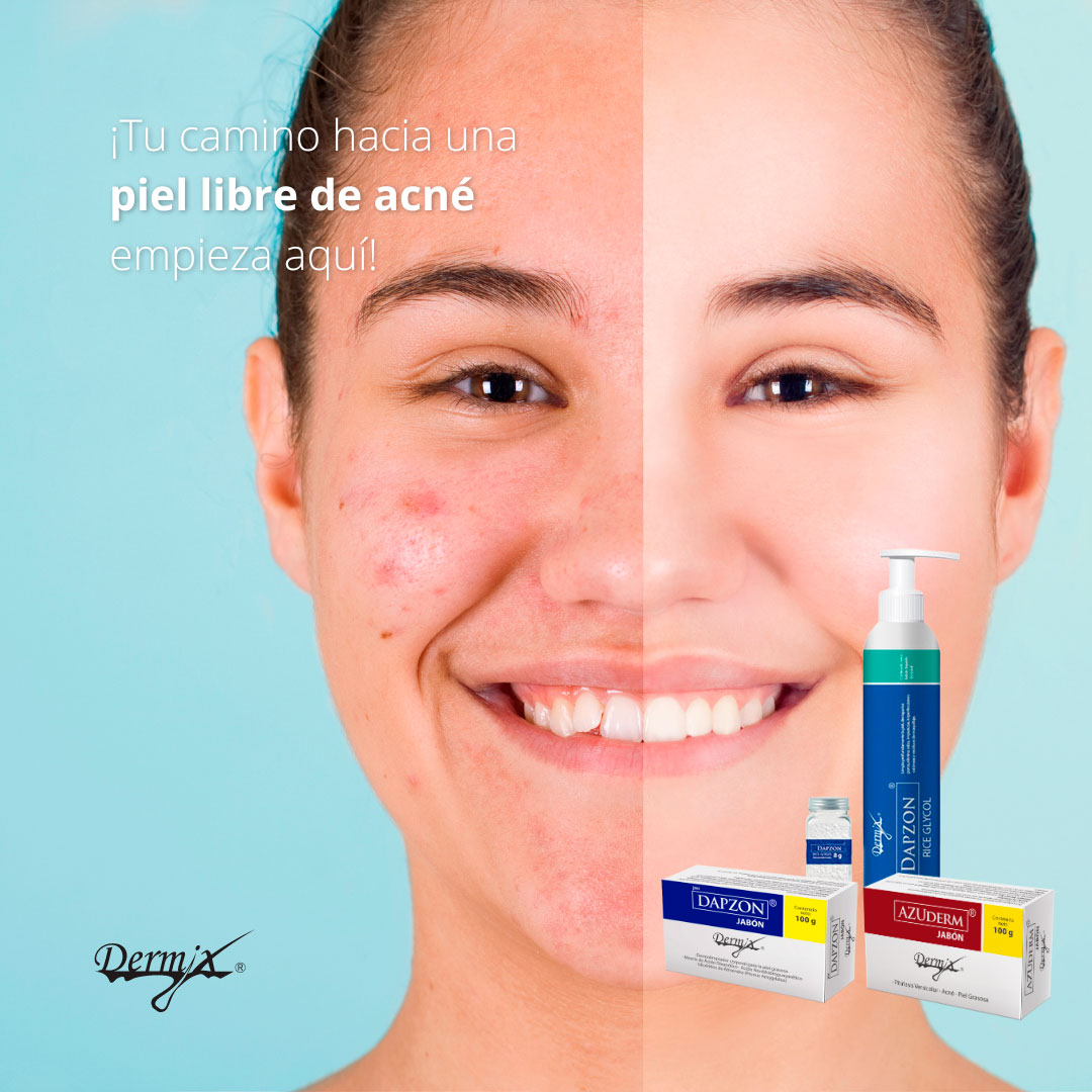 Rutina Anti Acné || Dermix